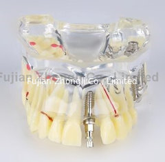 China dental caries dental bridge dental teaching communication oral implant nail demonstration model supplier