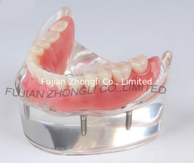 China Dental 4 Implants Locator Lower Arch Model supplier