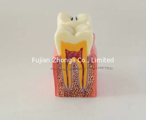 China Dental Six times dental caries contrast model teaching demonstration communication oral model pathology dental supplier
