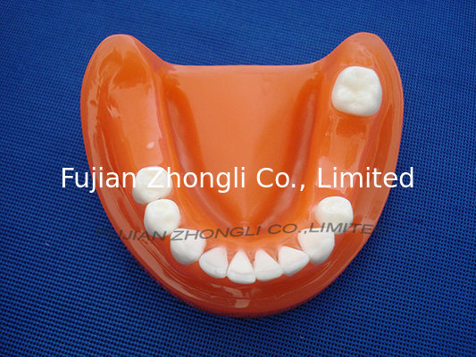 dental model for partial denture restorative supplier