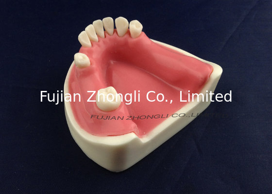 medical science dental implant model with soft gingiva supplier