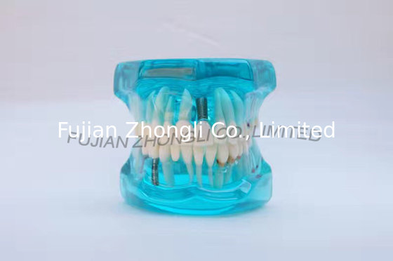 Dentist Dental Implant Disease Teeth Model with Restoration &amp; Bridge Tooth Study supplier