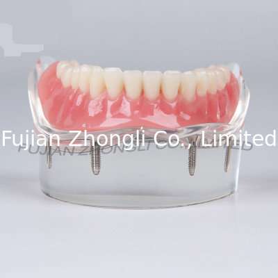 dental 4 impants hybrid denture combination lower arch model supplier