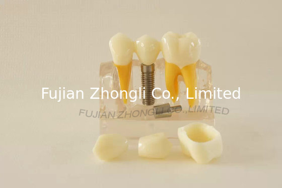 Dental Implant 3 Unit Bridge 3 Crowns Set of 6 Parts Model 4 Times Life-Size Reconstruction supplier