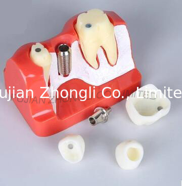 Dental Implants 3 Units Bridge 2 Crowns Reconstruction supplier