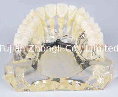 Transparent base station on both sides of the implant nail bridge demonstration supplier