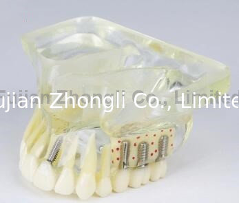 transparent sinus lift  implant model  Dental Model of osteoporosis dental materials supplier