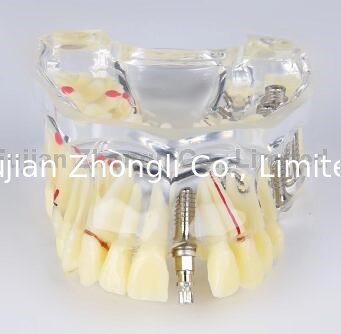 dental caries dental bridge dental teaching communication oral implant nail demonstration model supplier