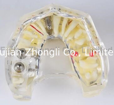 dental caries dental bridge dental teaching communication oral implant nail demonstration model supplier