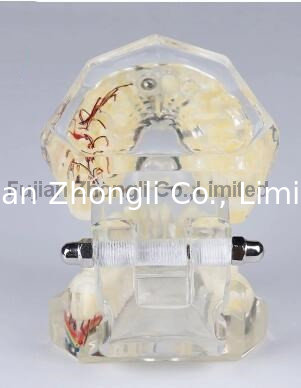 Transparent prothetic with implant model dental nerve demonstrate model doctor-patient communication model supplier