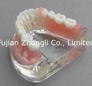 Dental 3 Implant 2 Unit Bridge of 3 Parts supplier