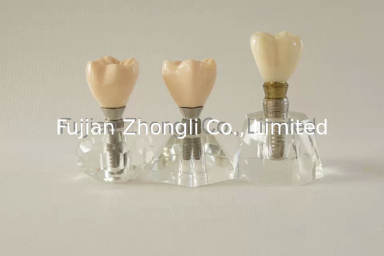 dental implant demonstration model of 5 parts supplier