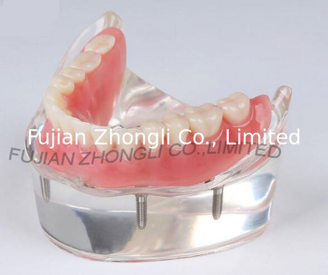 Dental 4 Implants Locator Lower Arch Model supplier