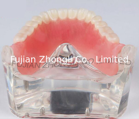 Dental 4 Implants Locator Lower Arch Model supplier