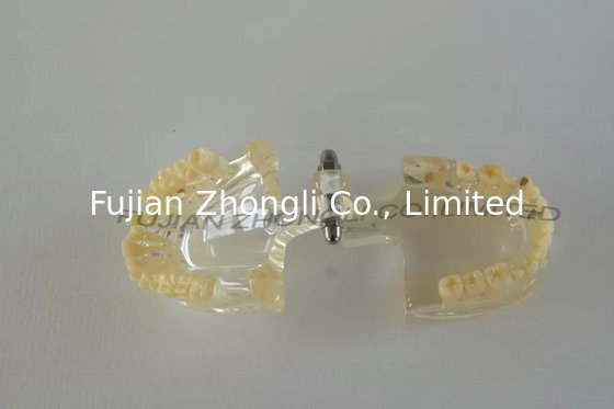 Dental half Multiple Pathologies Disease Implant Model and half Healthy Model supplier