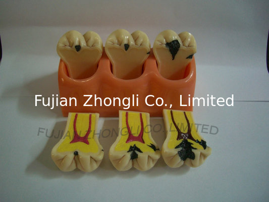 Dental 4 times size caries demonstrating model supplier