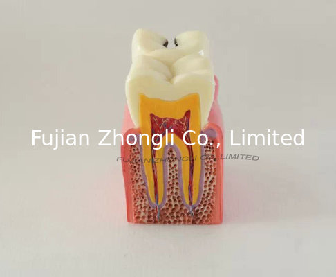 Dental Six times dental caries contrast model teaching demonstration communication oral model pathology dental supplier