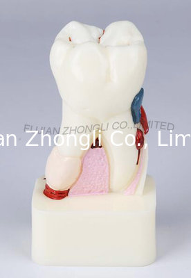 4 times dental disease comprehensive disease model dental caries dental calculus pulp stone occlusal wear pathological supplier