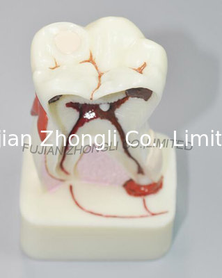 4 times dental disease comprehensive disease model dental caries dental calculus pulp stone occlusal wear pathological supplier