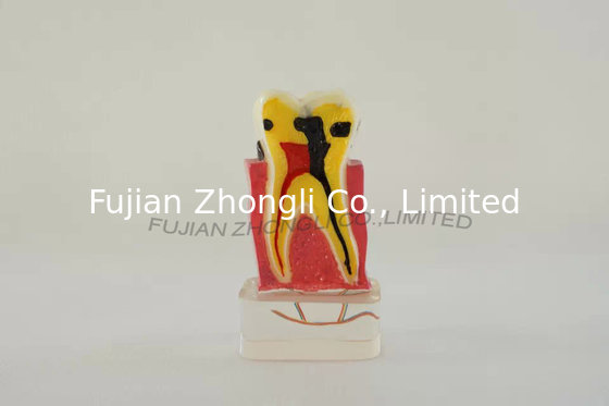 dental 4 times periodontal disease model with nerve model supplier