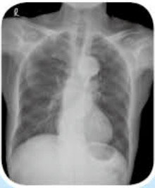 Película seca médica para el sitio del color y el endoscopio ultrasónicos del intestino del estómago