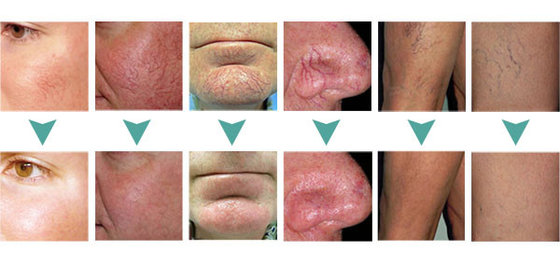 Spider Veins removal Machine Derma Wand laser spider vein removal machine