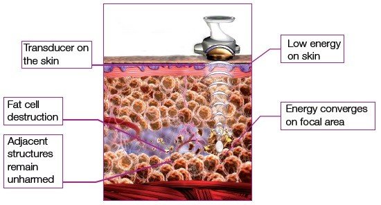 HIFU slimming machine vacuum radio frequency infrared slimming machine