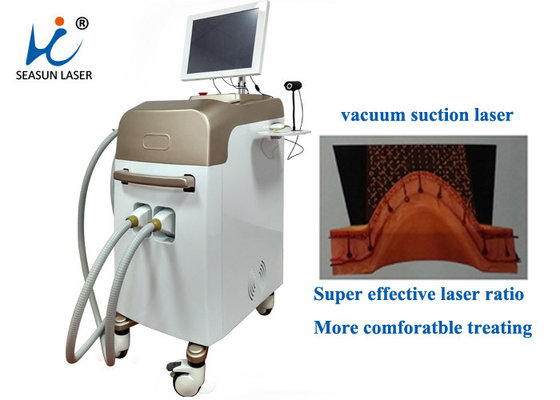Vacuum Laser Therapy Lightsheer Duet Diode Hair Removal Permanent For Face