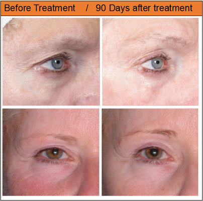 Hifu Face lifting Beauty mahcine/HIFU Machine/ HIFU Face Lift with Lowest Price / high int