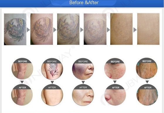 Amazing Discount! beauty medical laser nd yag for tattoo removal age pigment freckle removal