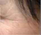 PDT Home Beauty Device , Vertical Scars Wrinkle Removal Machine