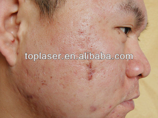 Stationary PDT Skin Rejuvenation LED Theraphy Device Acne Fine Lines Treatment