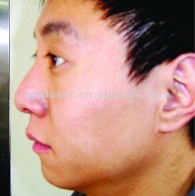 Portable Design PDT Skin Rejuvenation Acne Scarring Three Colour No Downtime