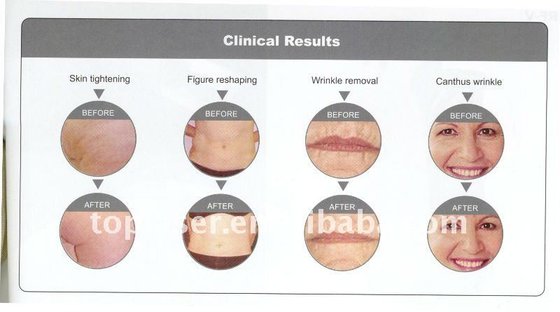 Convenient Design E-Light IPL RF Cooing System Intense Pulsed Light