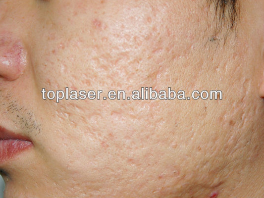 Co2 Fractional Laser Skin Tightening Machine / Anti Aging Machines Skin Care