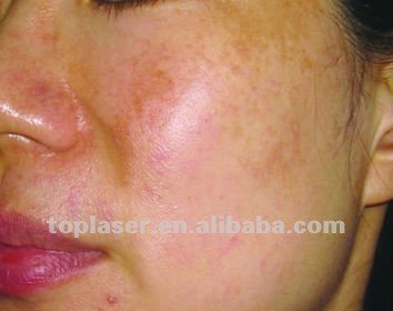 IPL Skin Rejuvenation Equipment E-light RF Skin Care Machine For Women