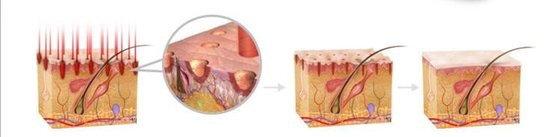 RF Tube Co2 Skin Rejuvenation Laser Machine , Laser Skin Care Machine