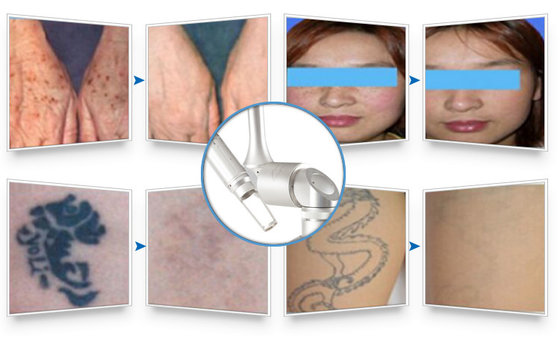 Medical Nd Yag Laser Tattoo Removal Machine Big 9.7 Inch TFT Touch Screen