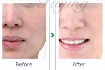 Skin Rejuvenation Oxygen Skin Treatment Machine With 500mm Jet Distance